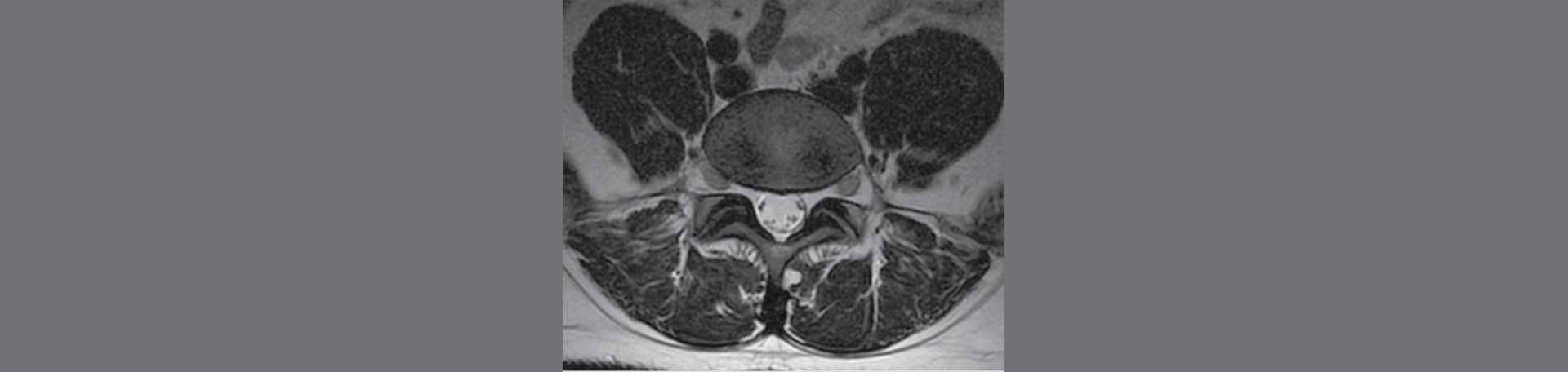 Revolutionizing Spinal Care: The Science Behind Disc Changes Post-Cox ...